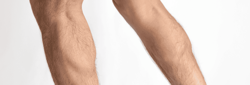 Calf Implant – Miracle Clinic